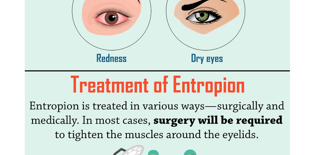 ENTROPION ( Eyelid Turned In) - Causes, Symptoms & Treatment by Pari ...