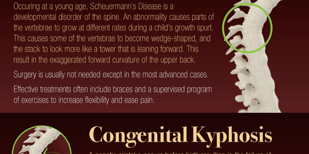 Types of Kyphosis and their Treatment - Infogram