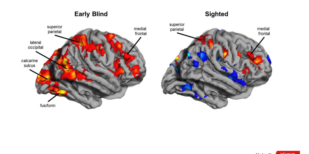 Brain Structure and Blindness Infogram by Alica McKinney - Infogram
