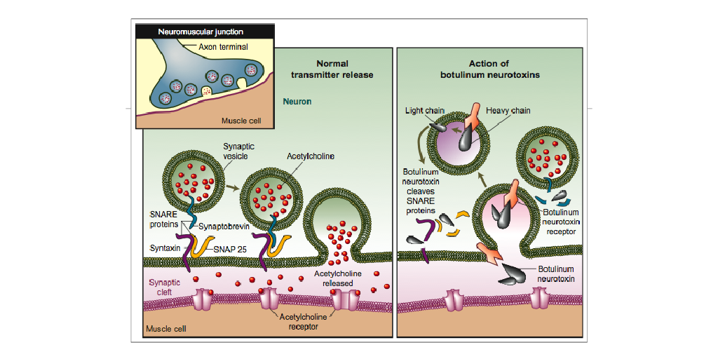 Botulinum Neurotoxin - Infogram